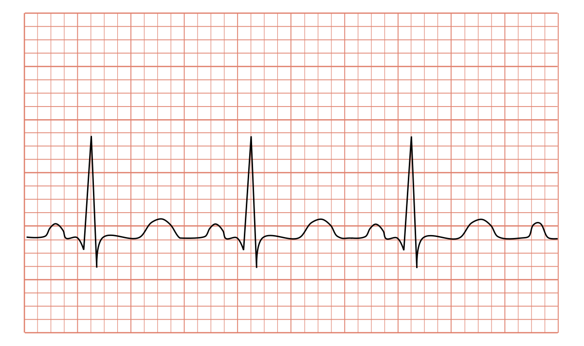 Increased heart rate - PsychonautWiki